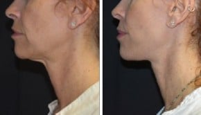 Before & After Photo Gallery | Kessler Plastic Surgery